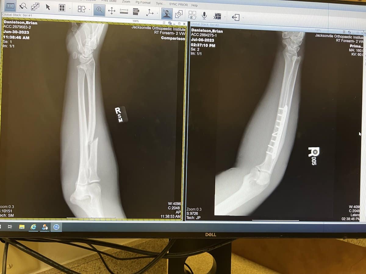Bryan Danielson Shows Off X-Rays, Comments On Undergoing Arm Surgery ...